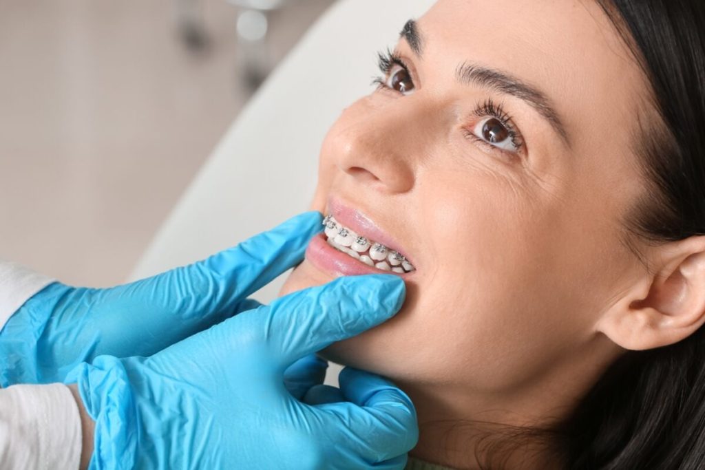 How Do Braces Work to Correct Your Teeth Alignment?